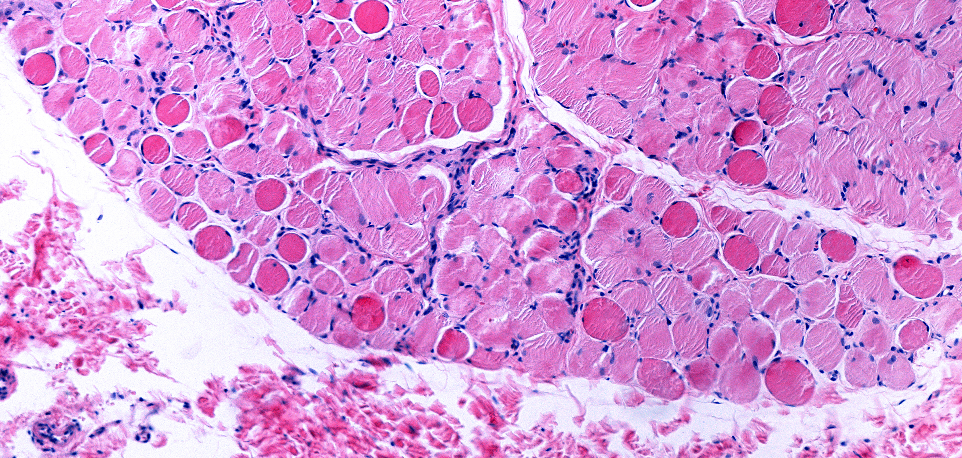Automated Utrophin Imaging for Duchenne Muscular Dystrophy